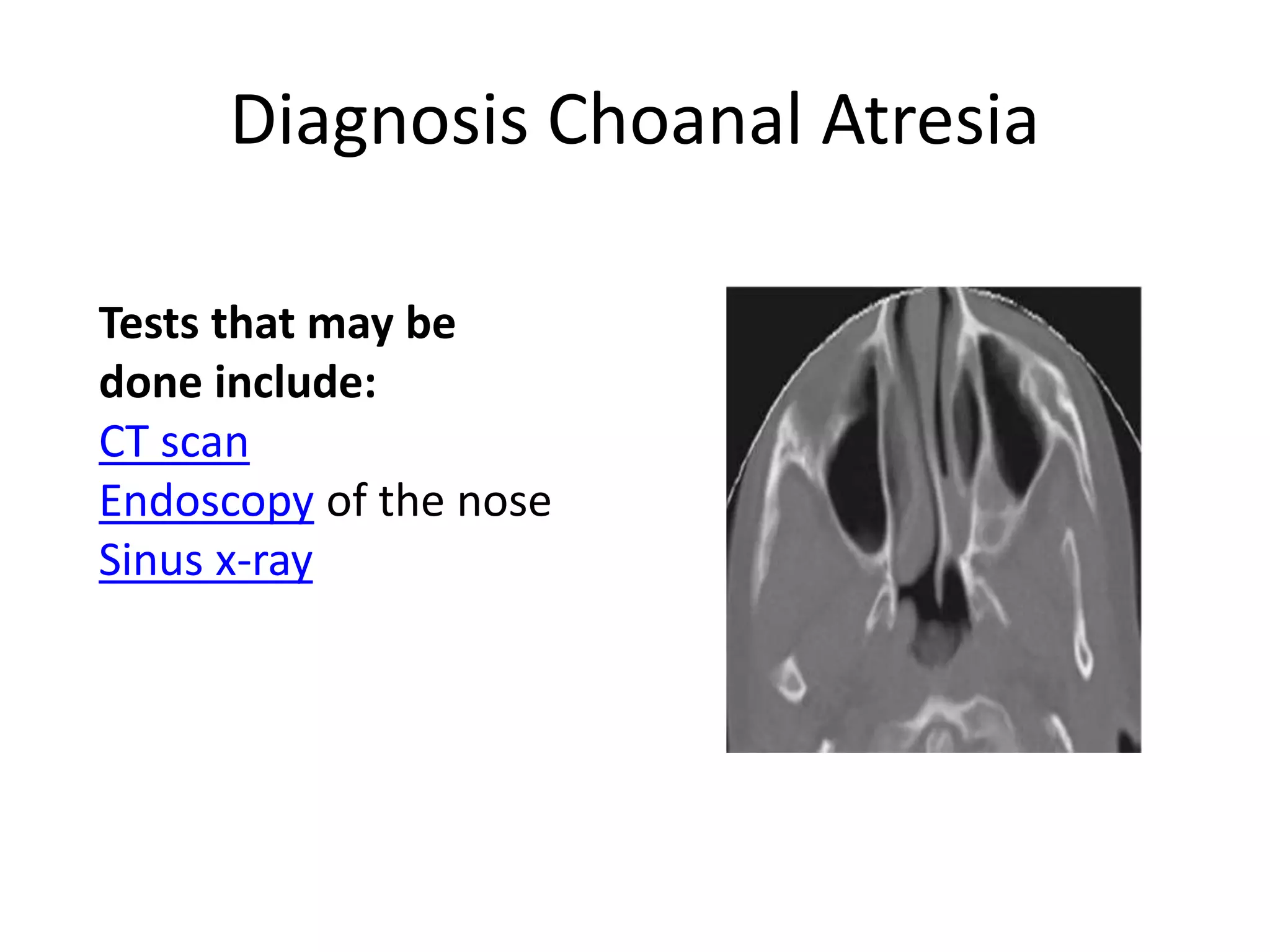 Choanal atresia | PPTX