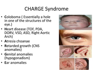 Choanal atresia | PPTX