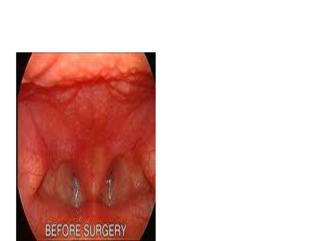 Choanal atresia | PPTX