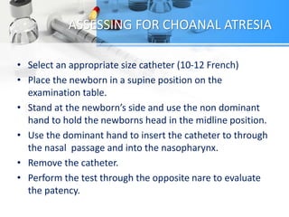 Choanal atresia | PPTX