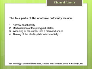 Choanal atresia | PPTX