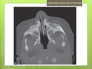 Choanal atresia | PPTX