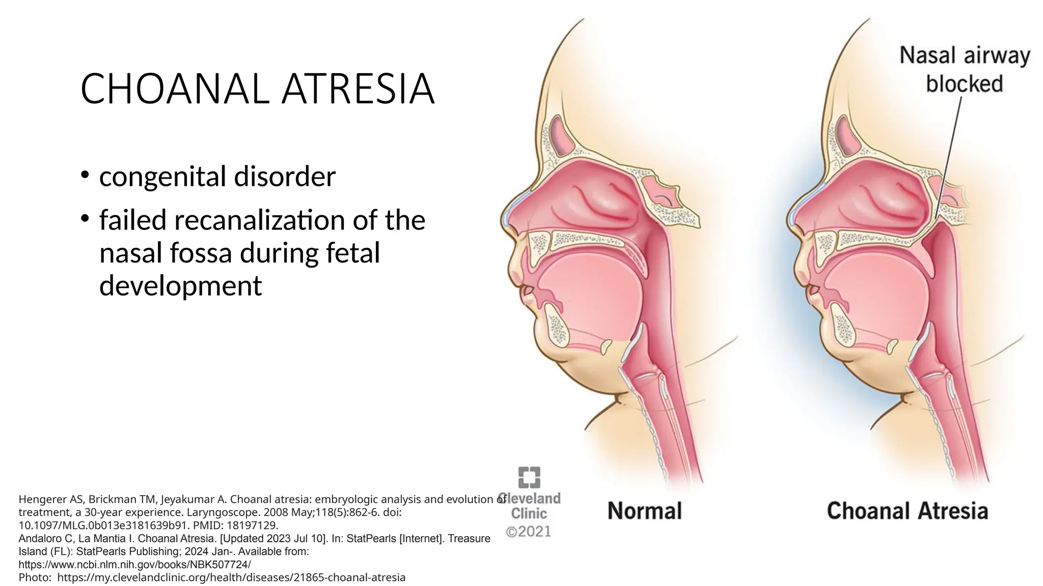 CHOANAL ATRESIA IN RELATION TO METHIMAZOLE USE | PPTX