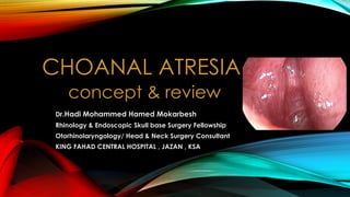 Choanal Atresia journal club surgical operations | PPTX