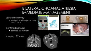 Choanal Atresia journal club surgical operations | PPT