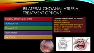 Choanal Atresia journal club surgical operations | PPTX