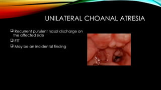 Choanal Atresia journal club surgical operations | PPTX
