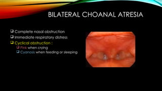 Choanal Atresia journal club surgical operations | PPTX