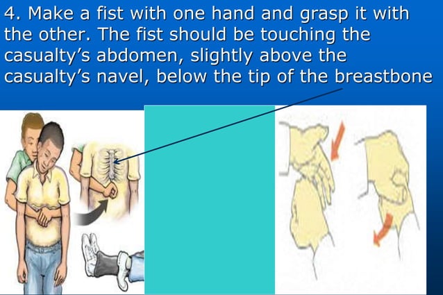 Choking | PPT | First Aid | Injuries