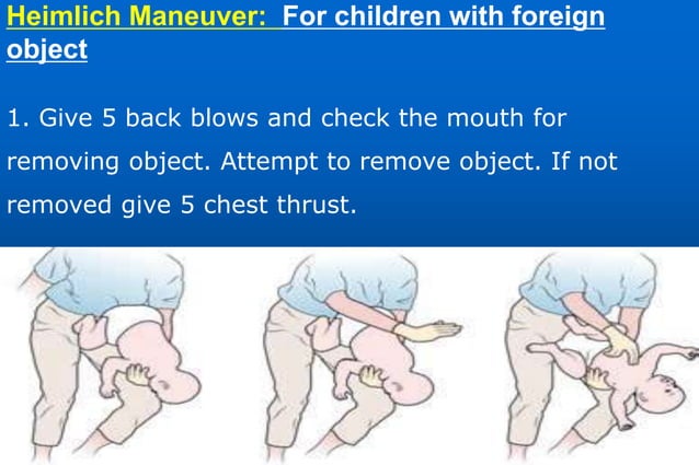 Choking | PPT | First Aid | Injuries