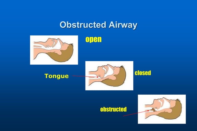 Choking | PPT | First Aid | Injuries