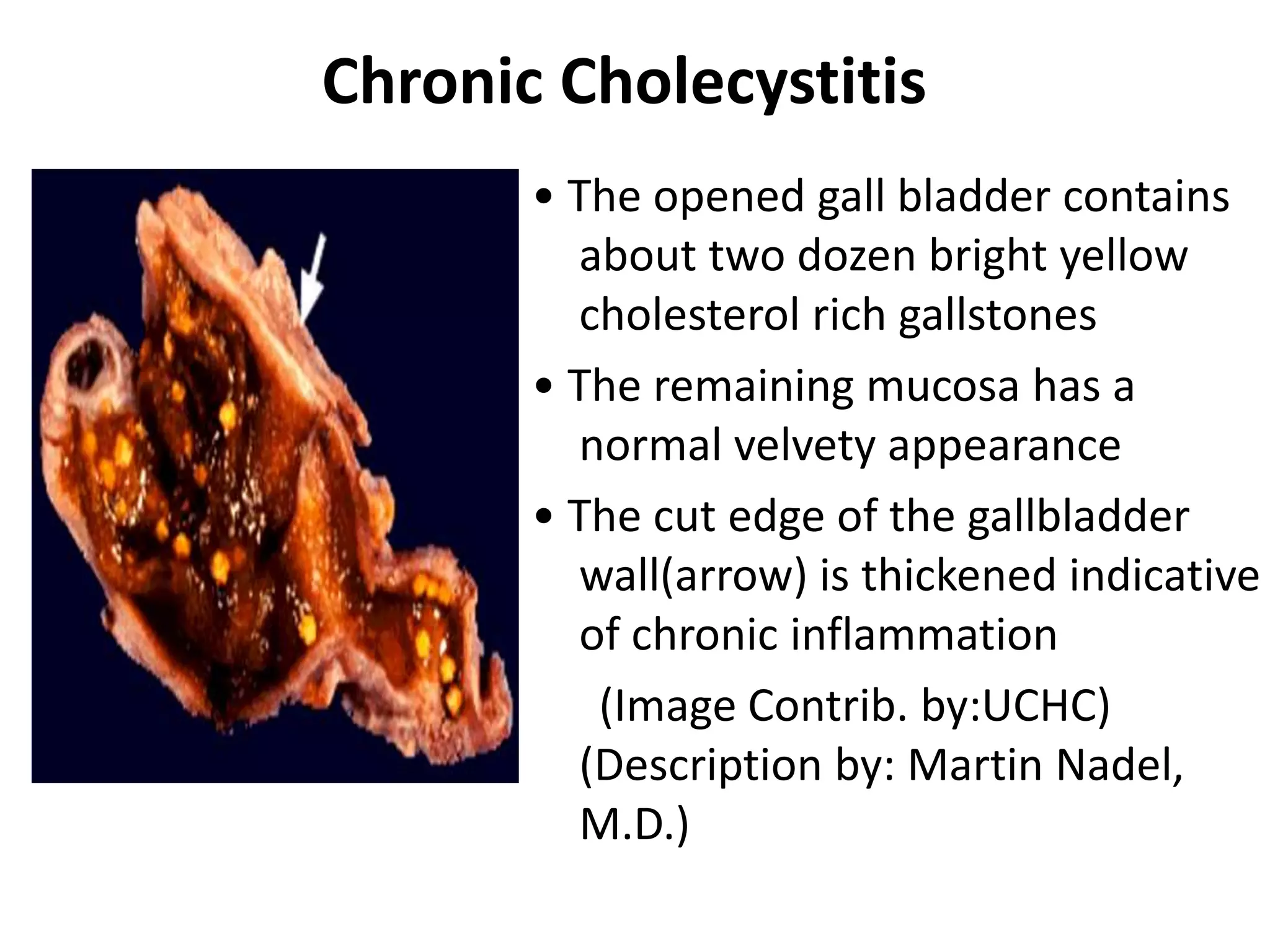 Choesystitis disease of GIT for nursing student | PPTX