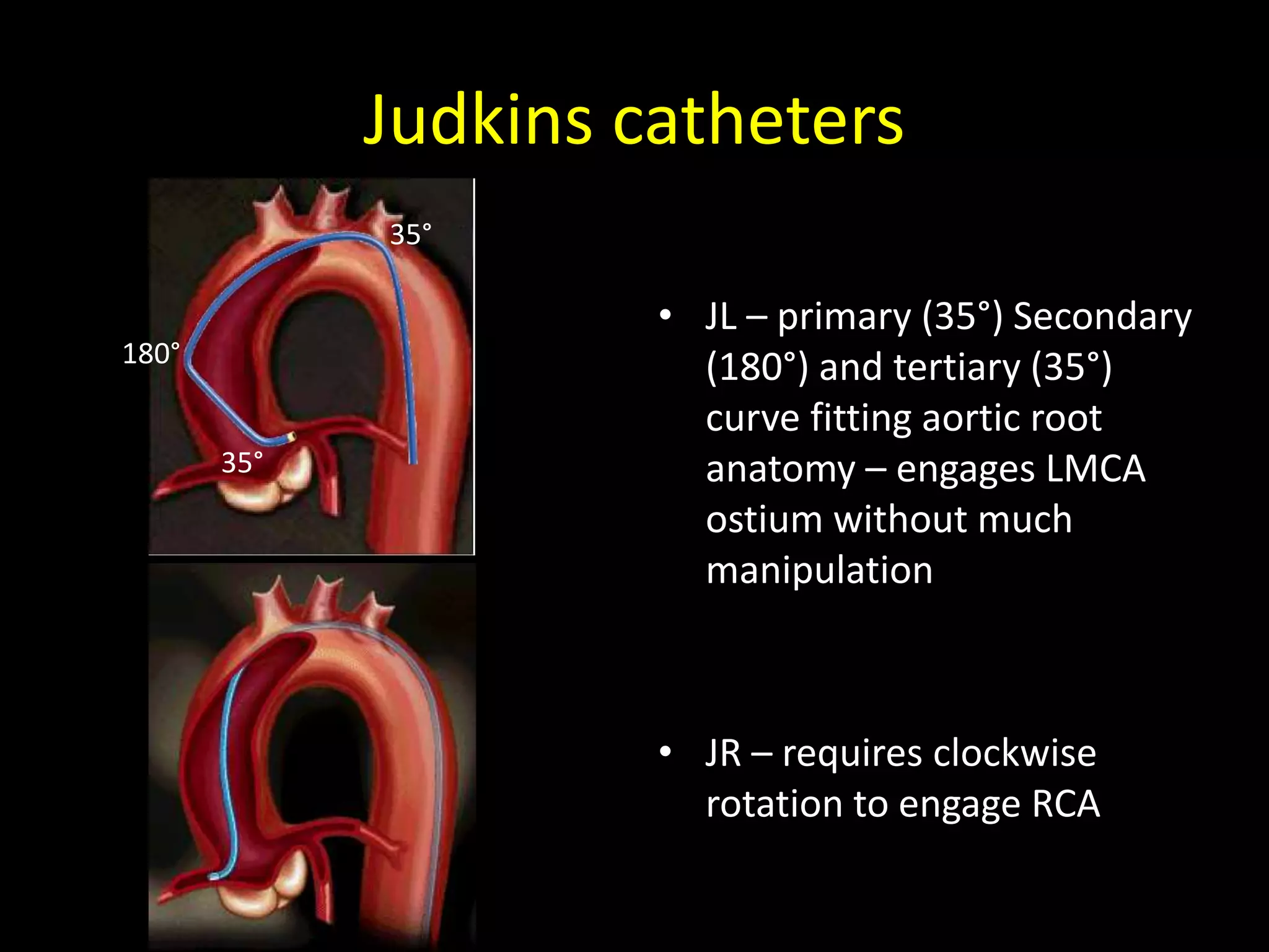 Choice of guiding catheters in PCI | PPTX
