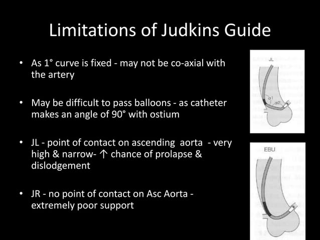 Choice of guiding catheters in PCI | PPTX