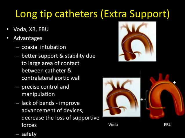 Choice of guiding catheters in PCI | PPT
