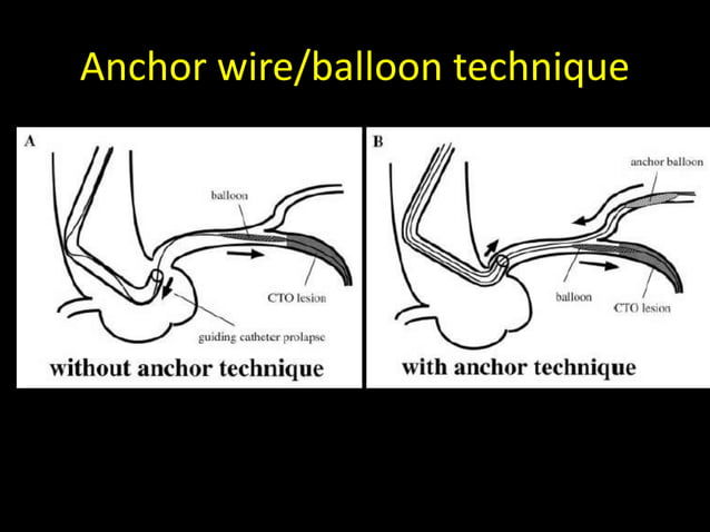 Choice of guiding catheters in PCI | PPT