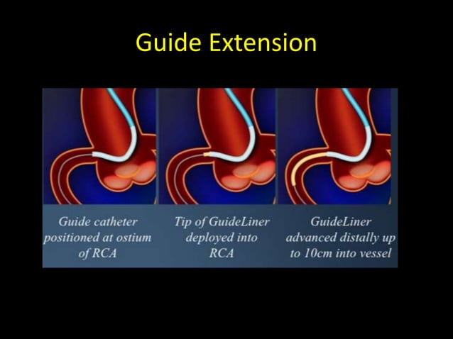 Choice of guiding catheters in PCI | PPTX