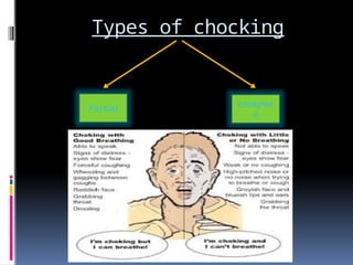Choking Management, for a school student | PPT
