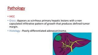 Cholangiocarcinoma | PPTX