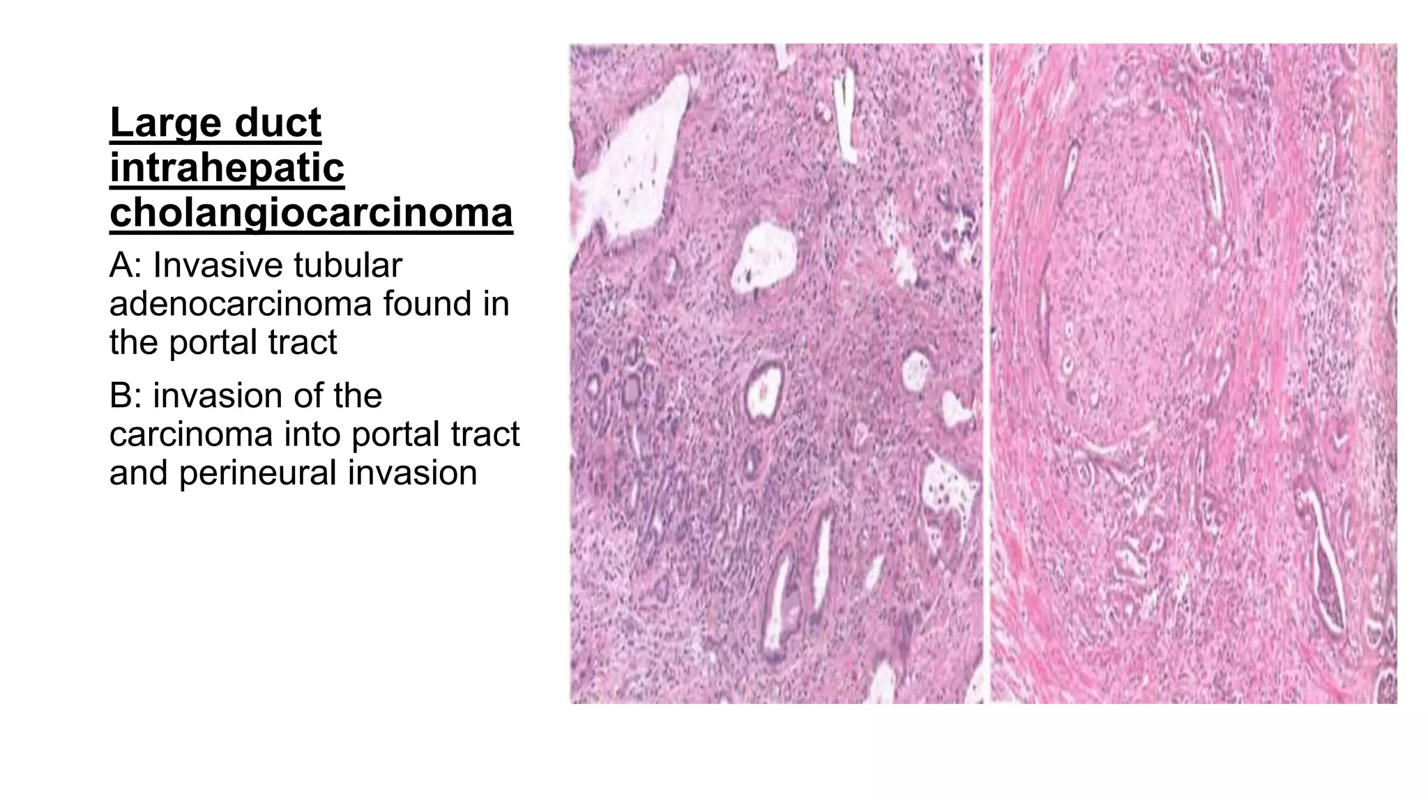 CHOLANGIOCARCINOMA.pptx