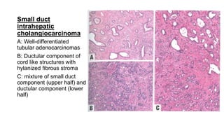 CHOLANGIOCARCINOMA.pptx