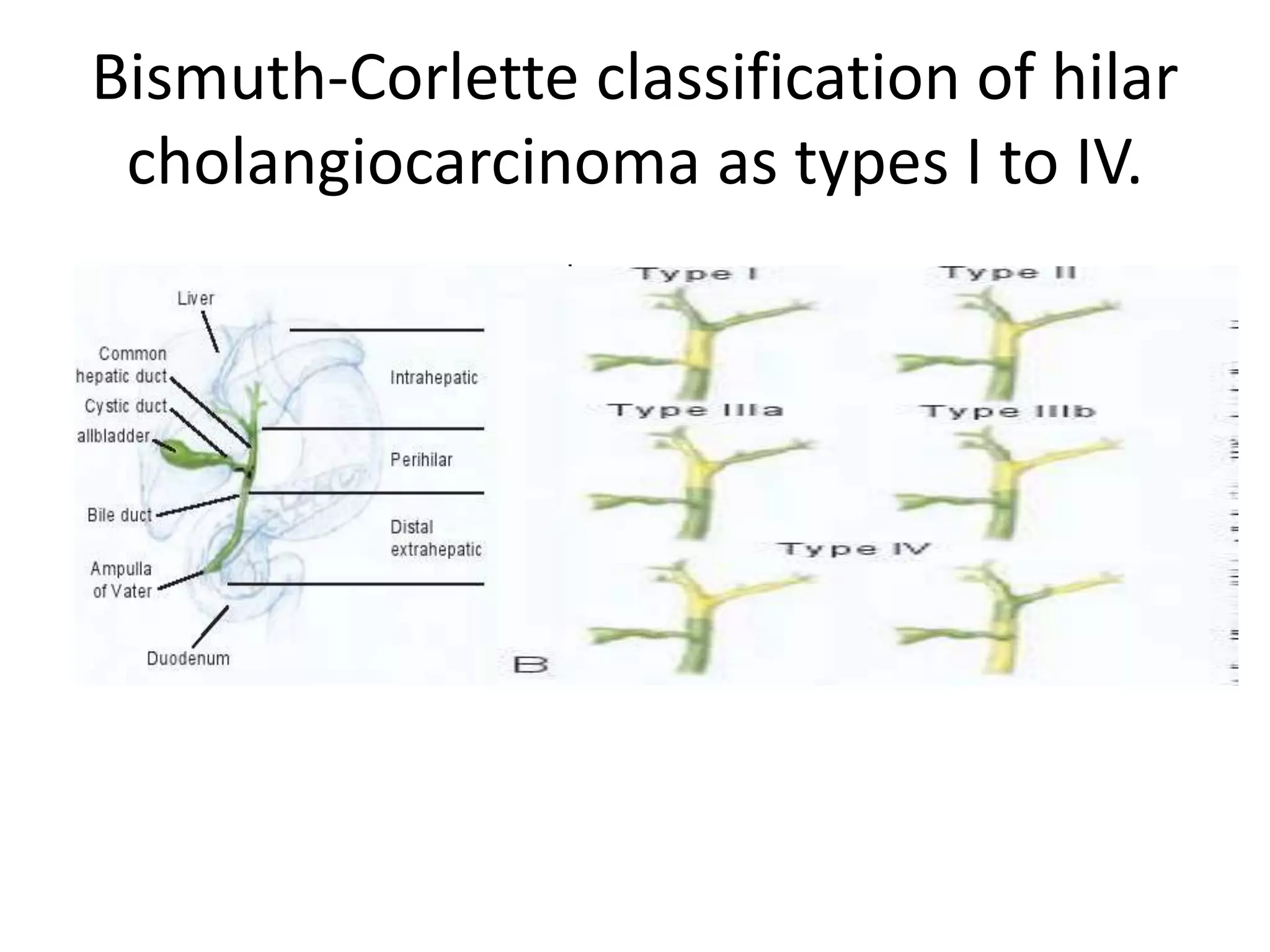 Cholangiocarcinoma ppt | PPTX