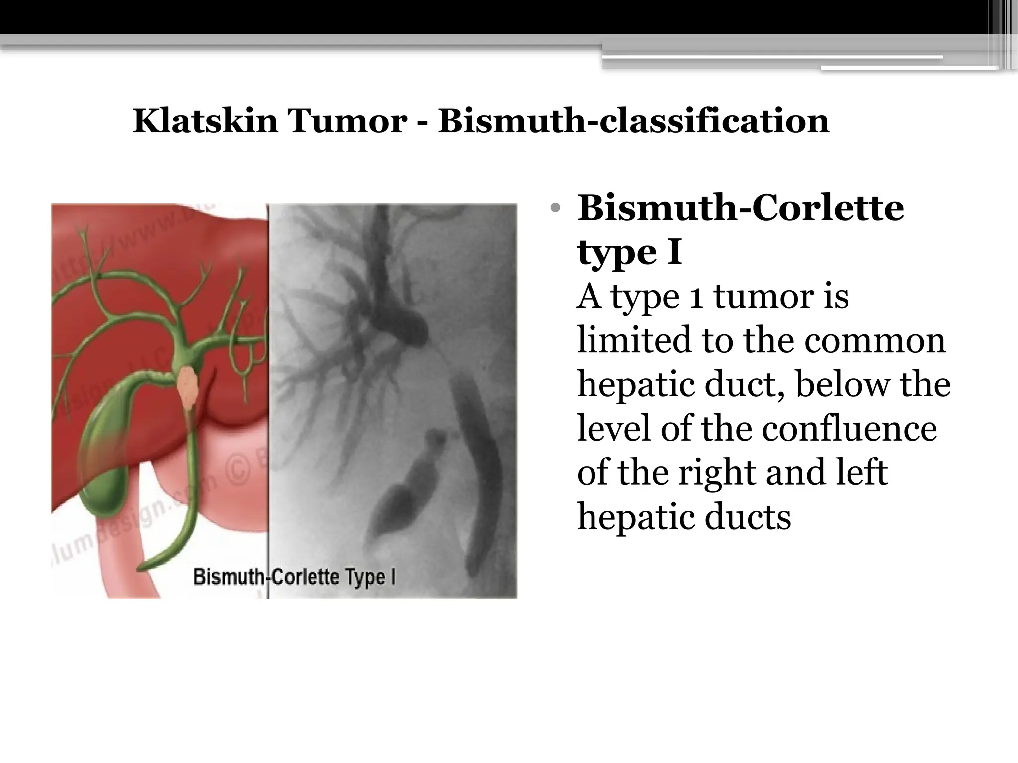 cholangiocarcinoma Sudhan Radiological Imaging | PPTX
