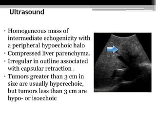 cholangiocarcinoma Sudhan Radiological Imaging | PPTX
