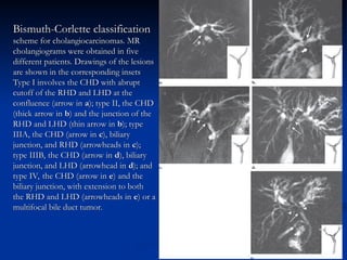Cholangiocarcinoma diagnosis and management the lect.ppt