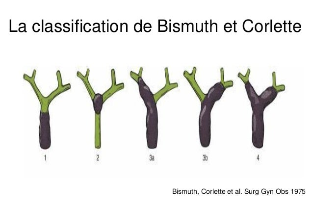 Diagnostic et traitement du cholangiocarcinome hilaire