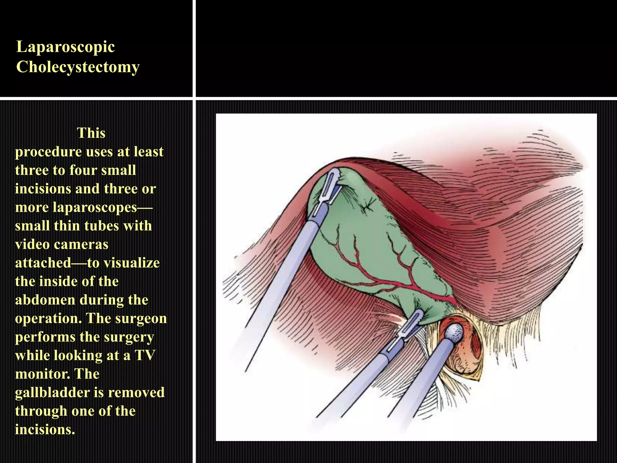 Cholecystectomy | PPTX