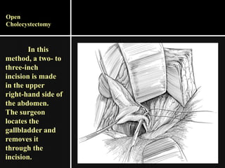 Cholecystectomy | PPTX