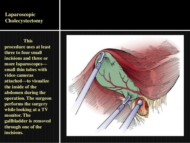 Cholecystectomy
