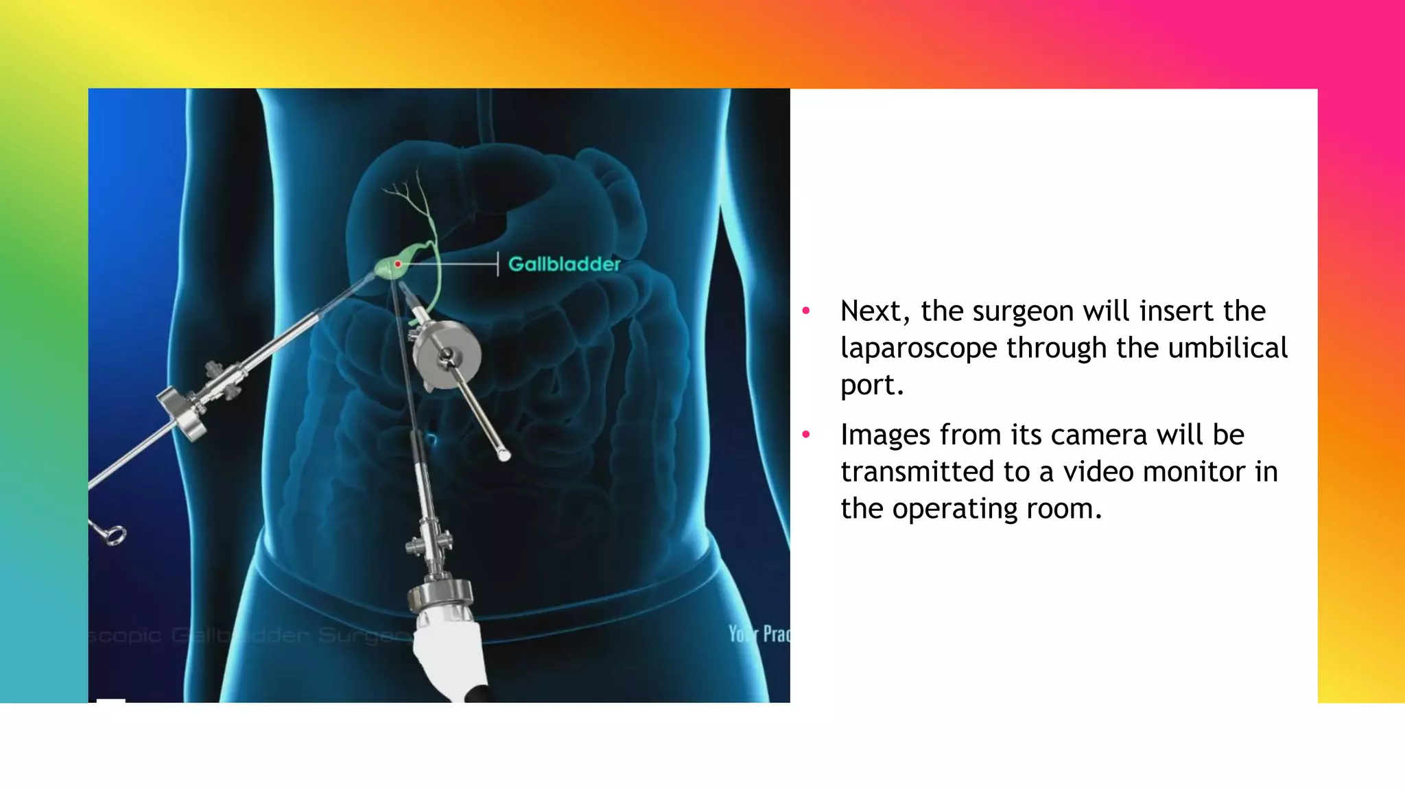 Cholecystectomy..pptx