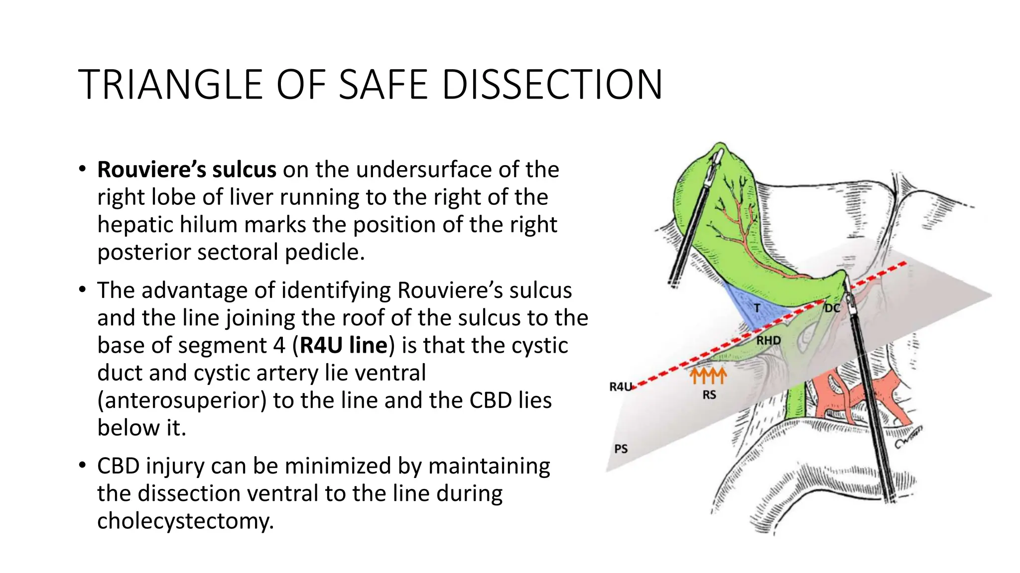 CHOLECYSTECTOMY - ANATOMY, TYPES, SURGICAL STEPS, ERRORS ...
