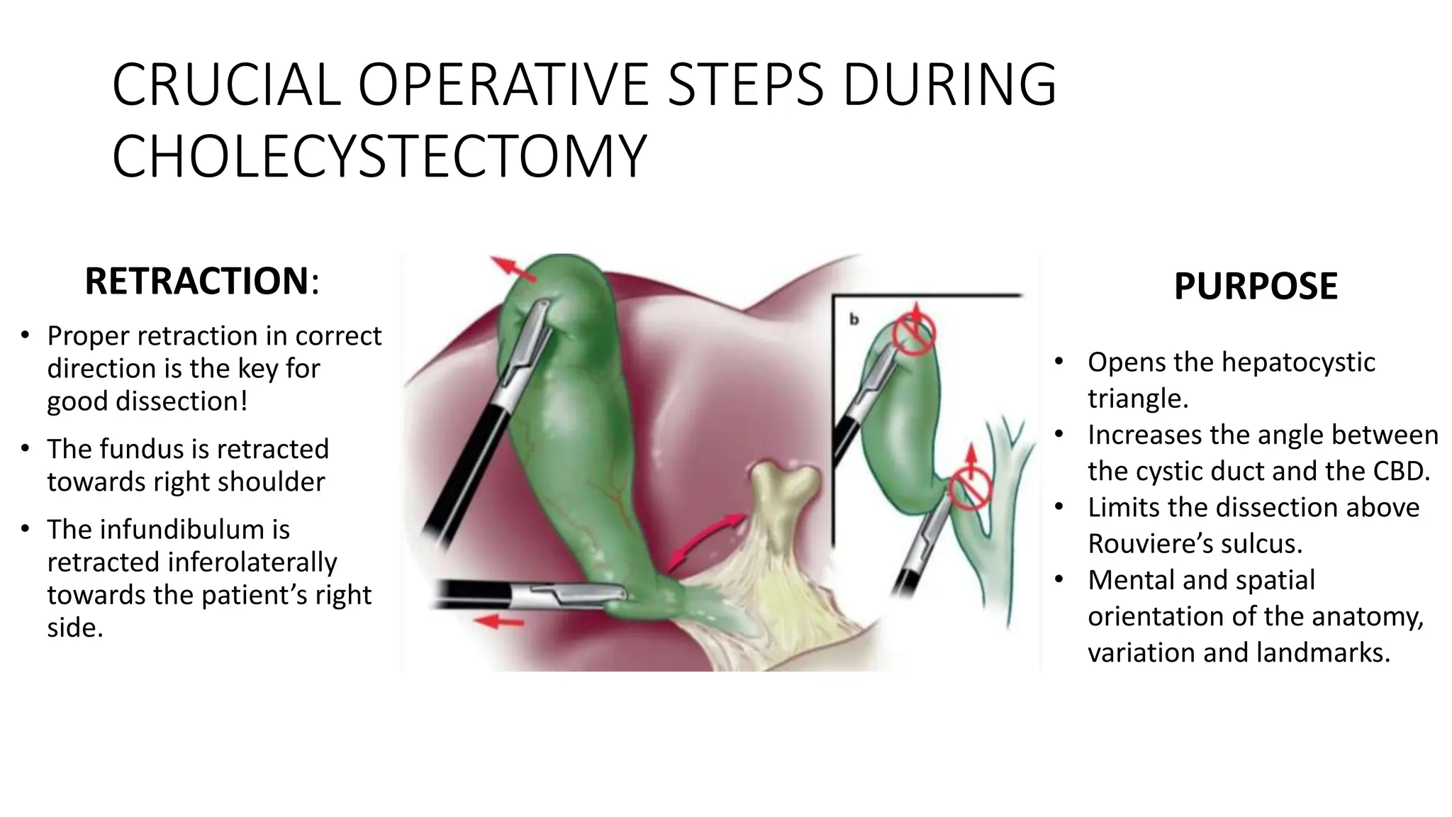 CHOLECYSTECTOMY - ANATOMY, TYPES, SURGICAL STEPS, ERRORS ...