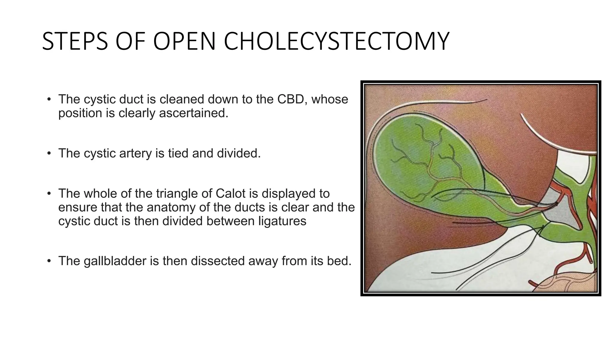CHOLECYSTECTOMY - ANATOMY, TYPES, SURGICAL STEPS, ERRORS ...