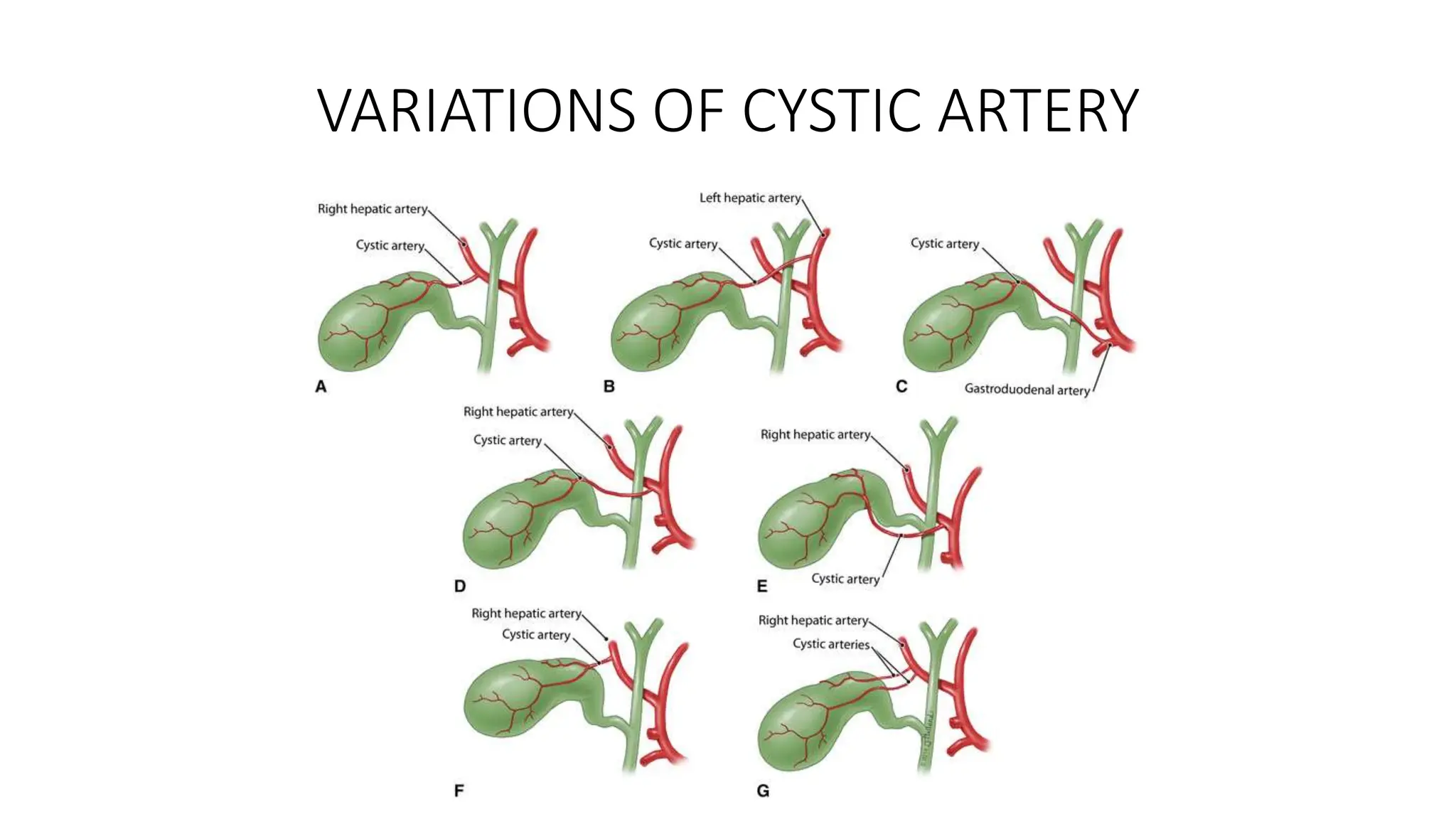 CHOLECYSTECTOMY - ANATOMY, TYPES, SURGICAL STEPS, ERRORS ...