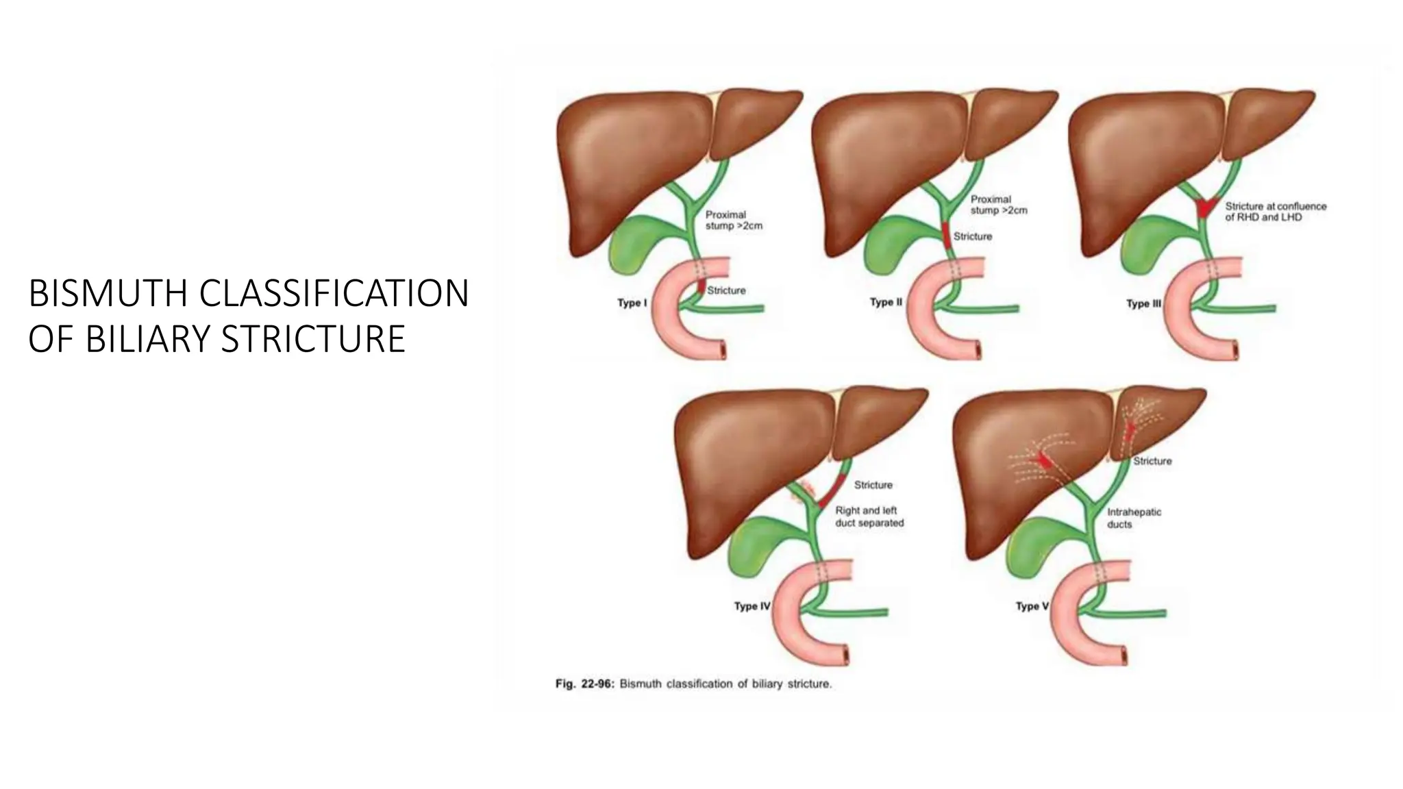 CHOLECYSTECTOMY - ANATOMY, TYPES, SURGICAL STEPS, ERRORS ...