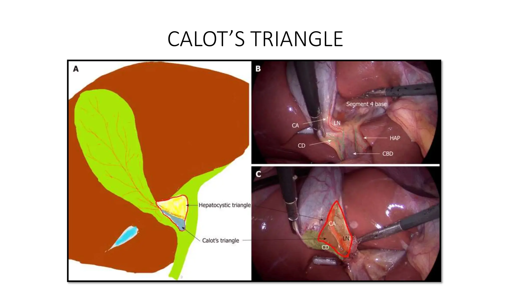 CHOLECYSTECTOMY - ANATOMY, TYPES, SURGICAL STEPS, ERRORS ...