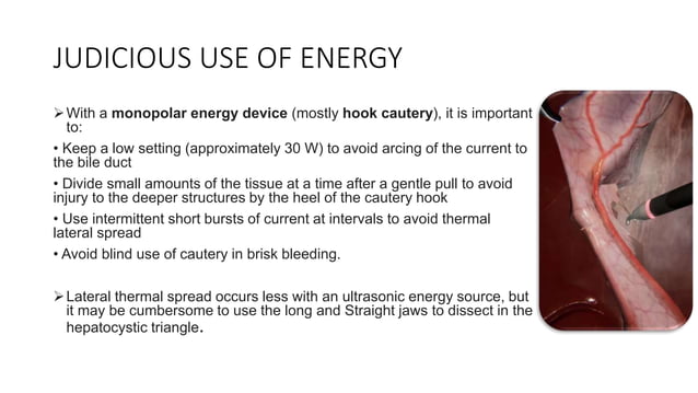 CHOLECYSTECTOMY - ANATOMY, TYPES, SURGICAL STEPS, ERRORS ...
