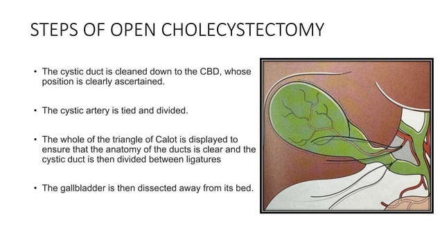 CHOLECYSTECTOMY - ANATOMY, TYPES, SURGICAL STEPS, ERRORS ...