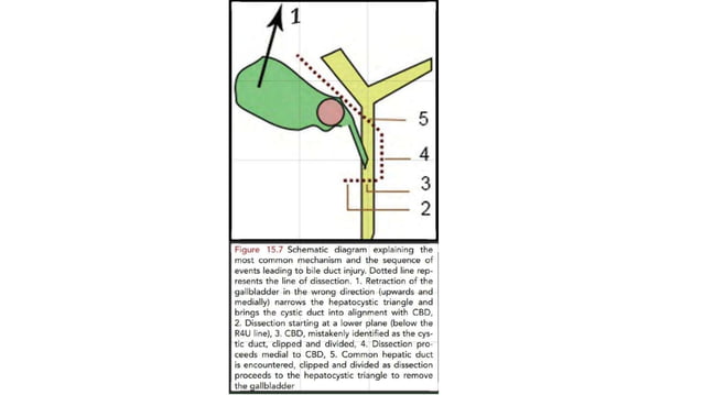 CHOLECYSTECTOMY - ANATOMY, TYPES, SURGICAL STEPS, ERRORS ...