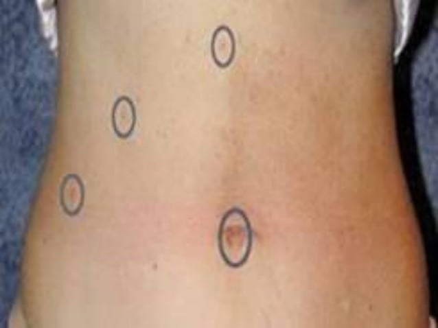 Cholecystectomy open versus laparoscopic surgery | PDF
