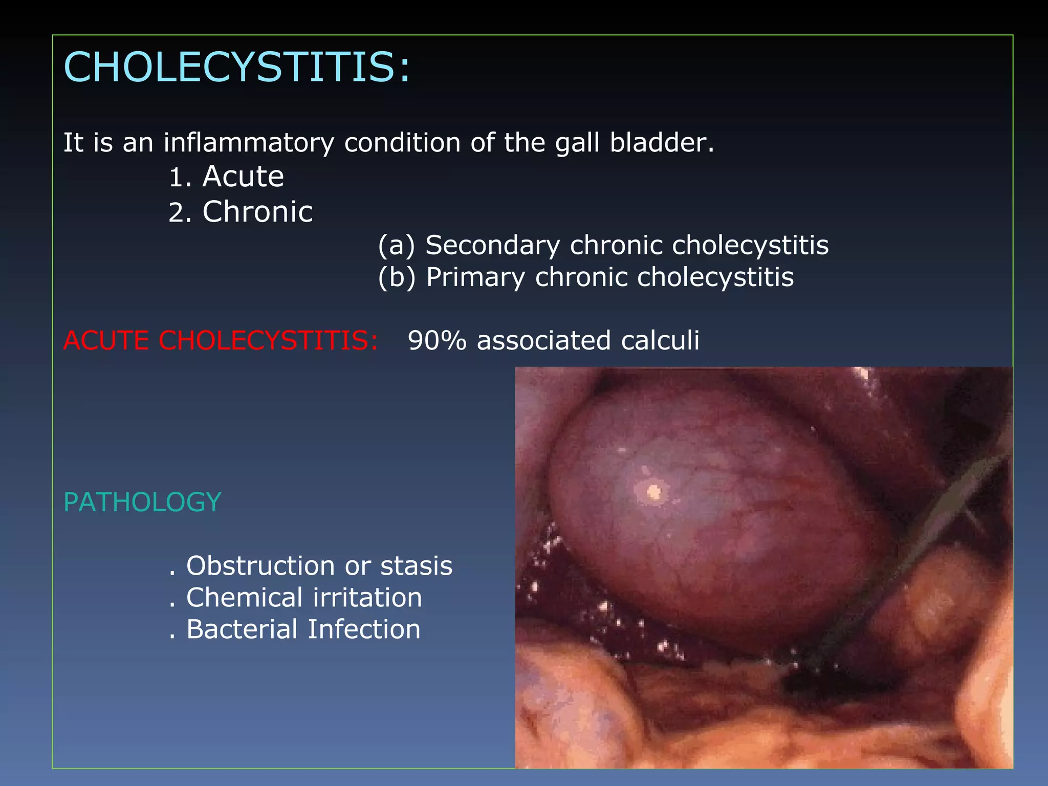 Cholecystitis | PPT