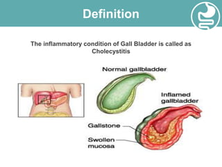 Cholecystitis | PPTX