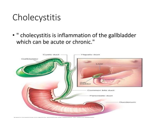 cholecystitis.pptx