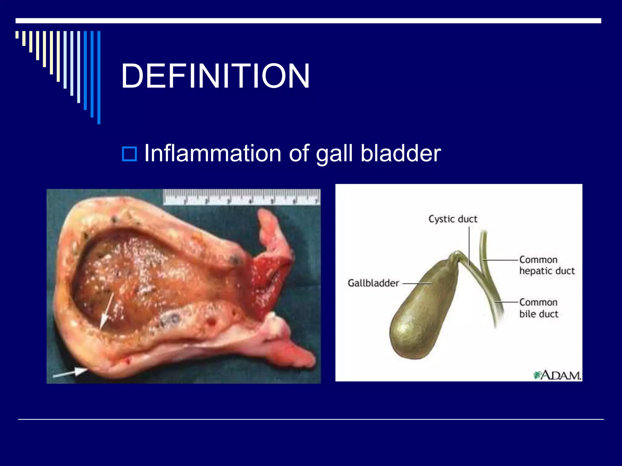 CHOLECYSTITIS.pptx