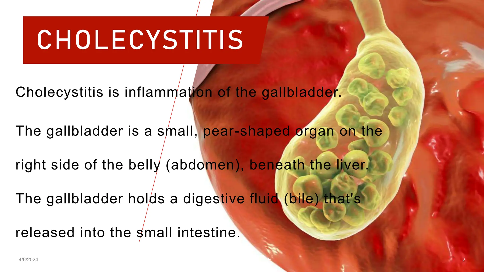 ACUTE CHOLECYSTITIS, INCIDENCE, PATHOPHYSIOLOGY, ETIOLOGY, RISKFACTORS.pptx