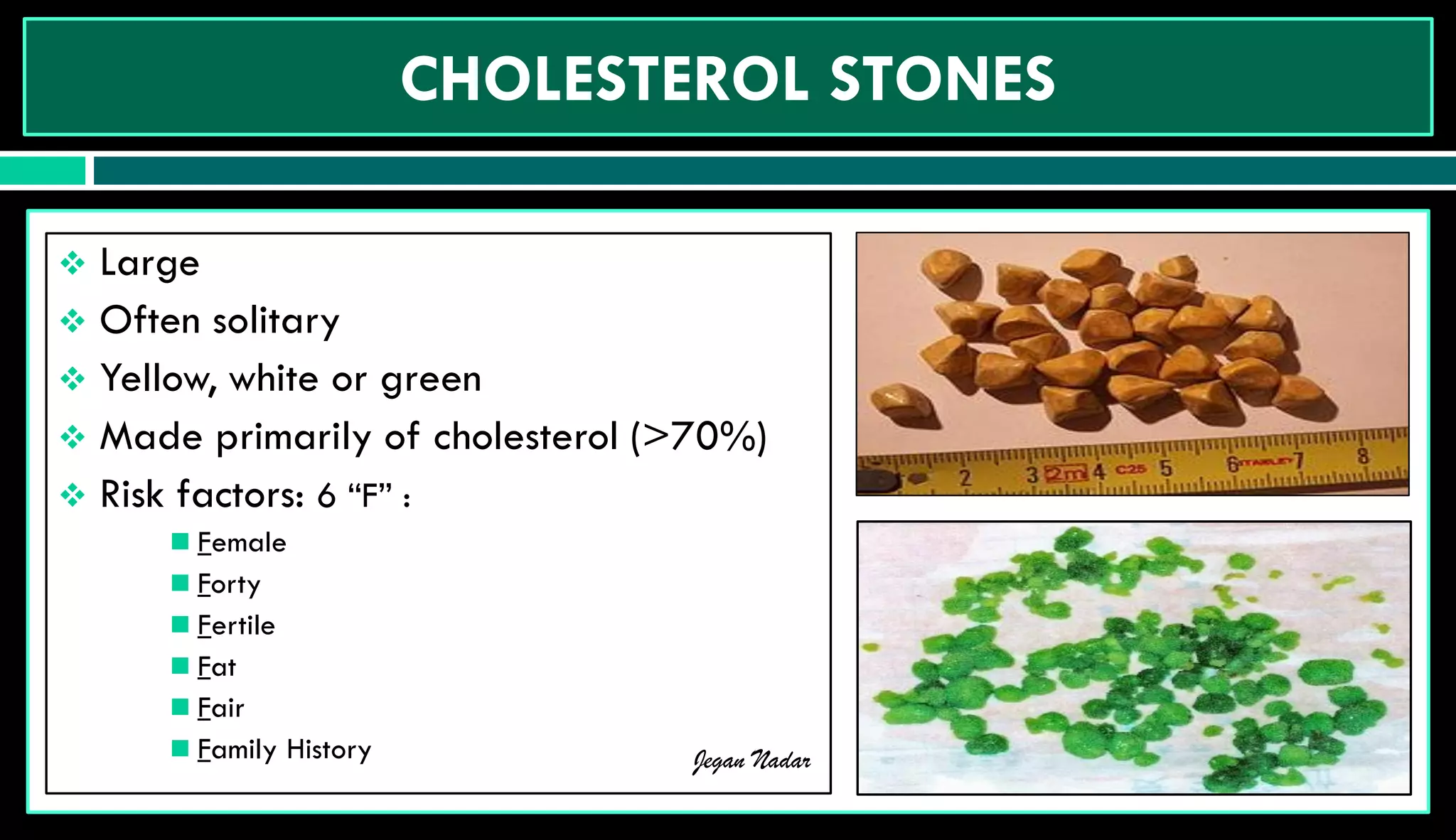 Pathophysiology of Cholecystitis and cholelithiasis | PDF | Digestive ...